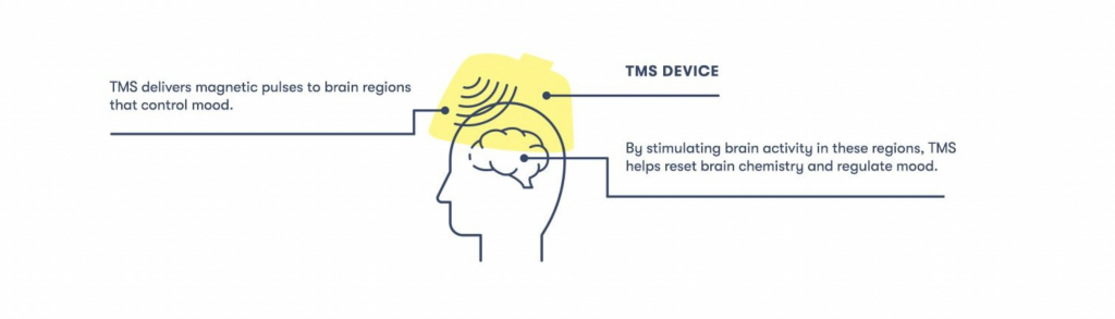The Basics of Transcranial Magnetic Stimulation - Heading Health