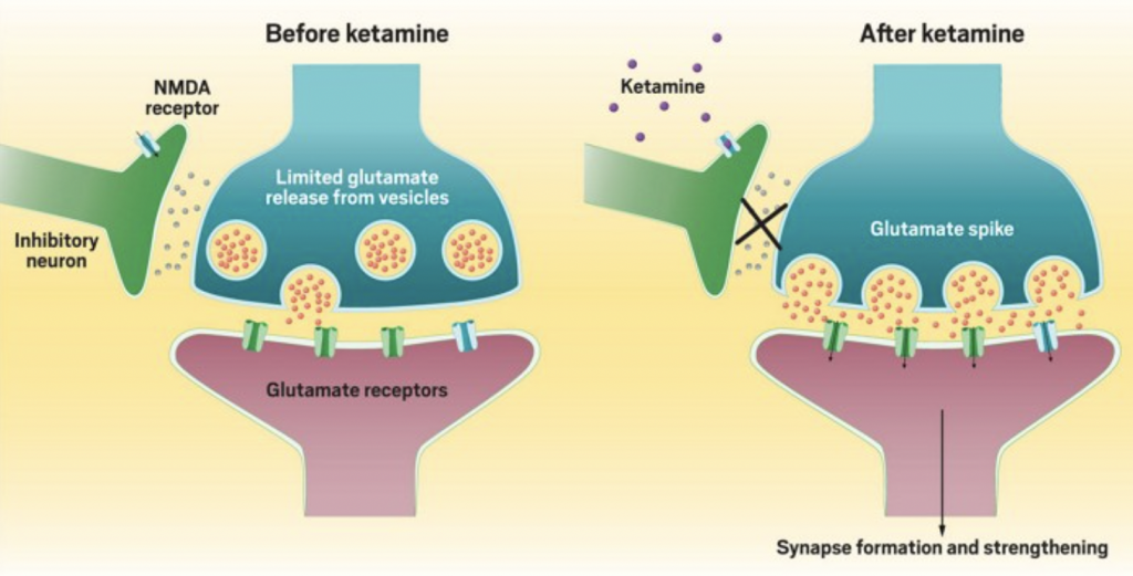 How Ketamine Works Quickly When Other Treatments Have Failed - Heading ...